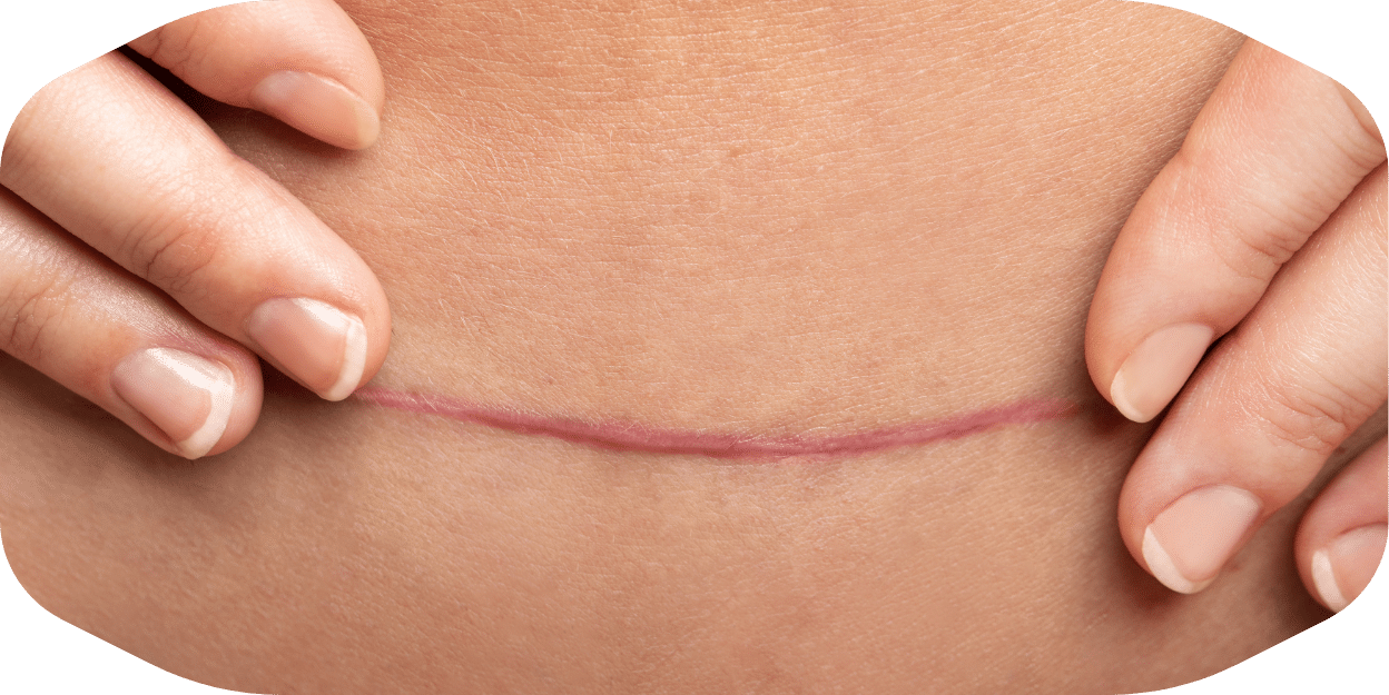 Narbenbehandlung | Narbicum Konzept